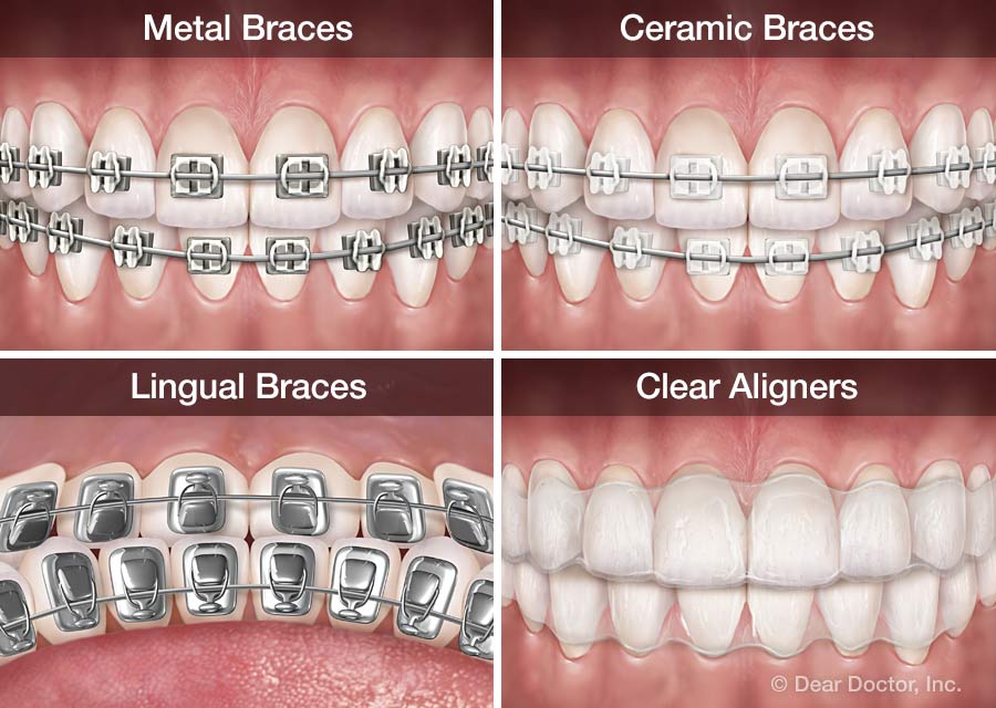 Dentofacial Orthopedics/Aligners | R K Dental Clinic